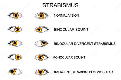 Ogen soorten scheelzien vector illustratie. Illustration of anatomie ...