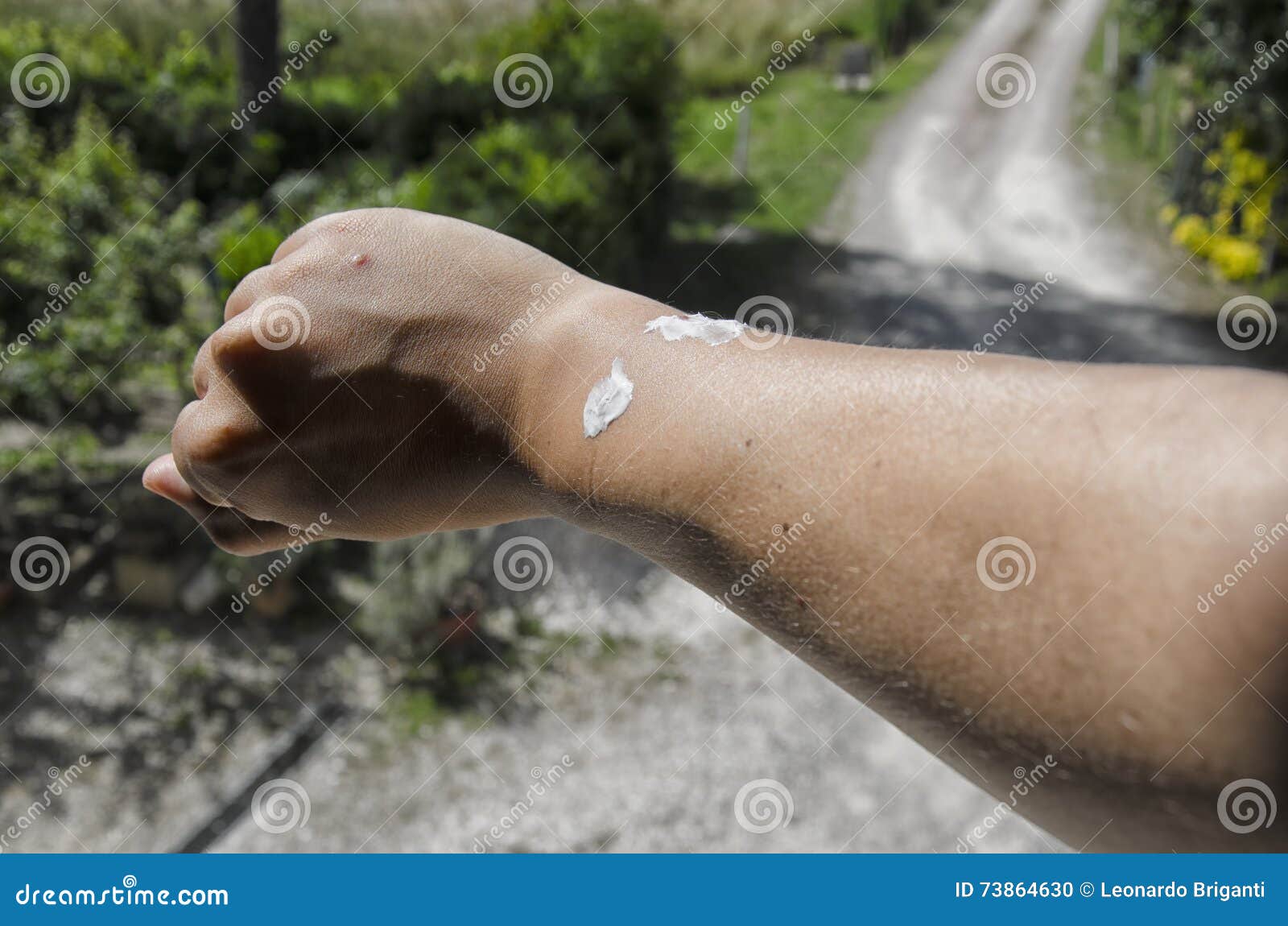 Ointment To Treat a Spider Bite Stock Photo - Image of medicine, wasp ...