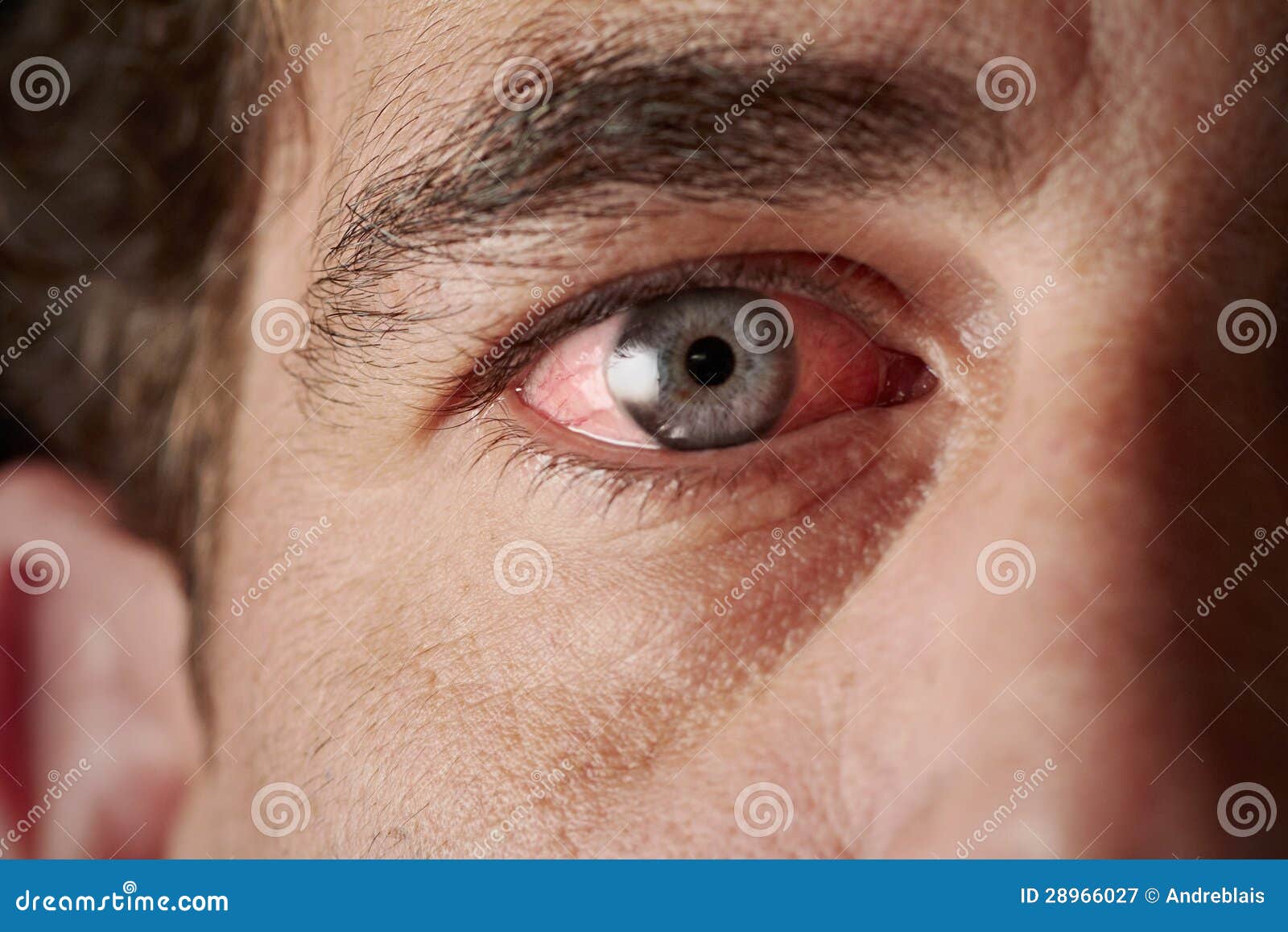 Ojo inyectado en sangre imagen de archivo. Imagen de glaucoma - 28966027