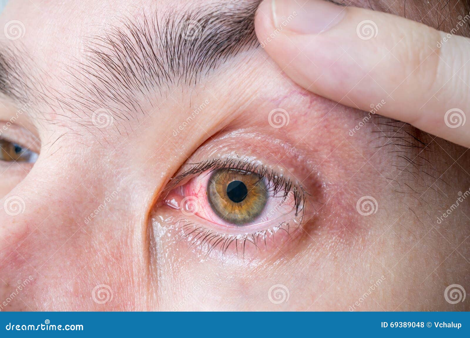 Ojo rojo irritado y herido foto de archivo. Imagen de primer - 69389048