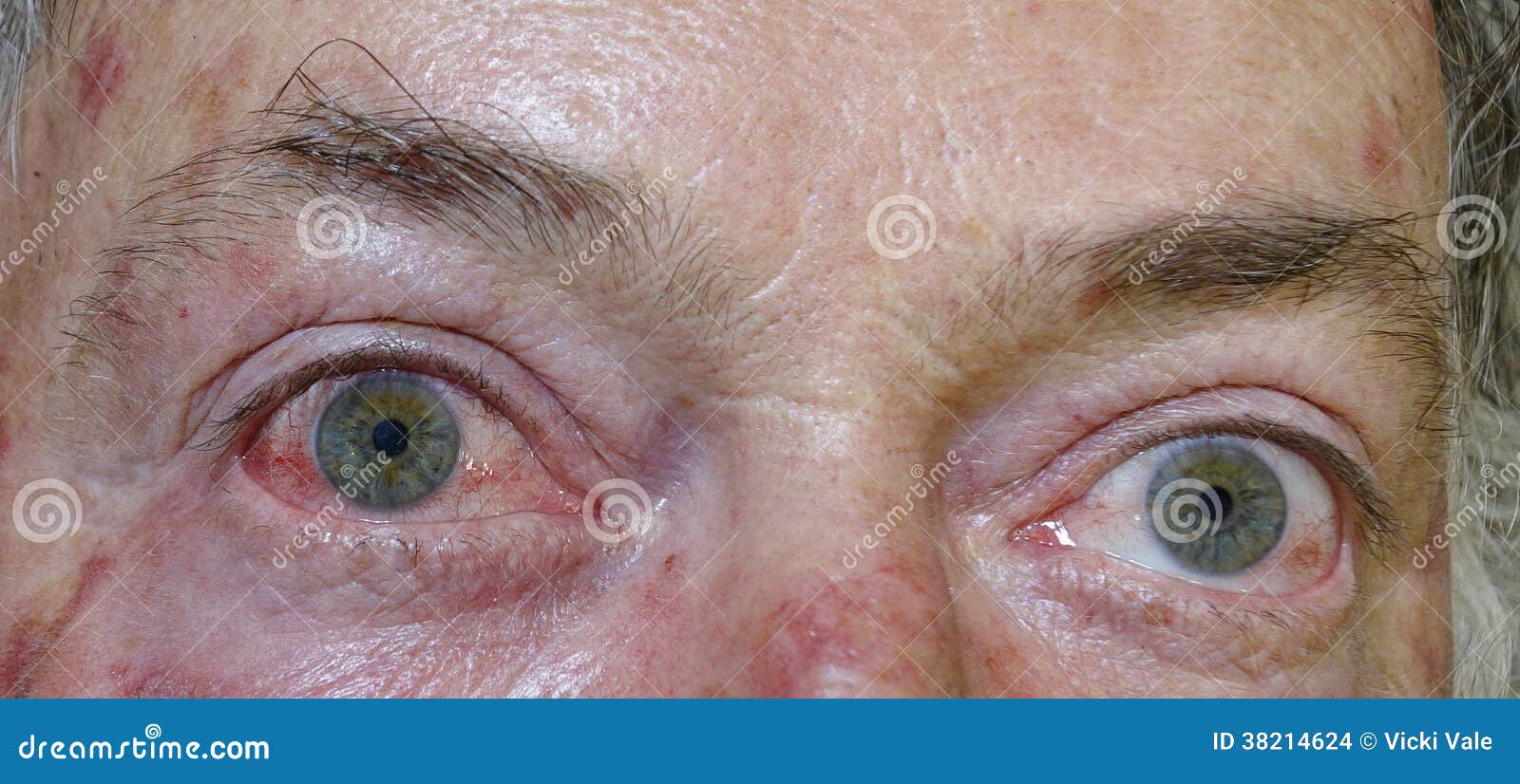 Ojos irritados. foto de archivo. Imagen de diafragma - 38214624