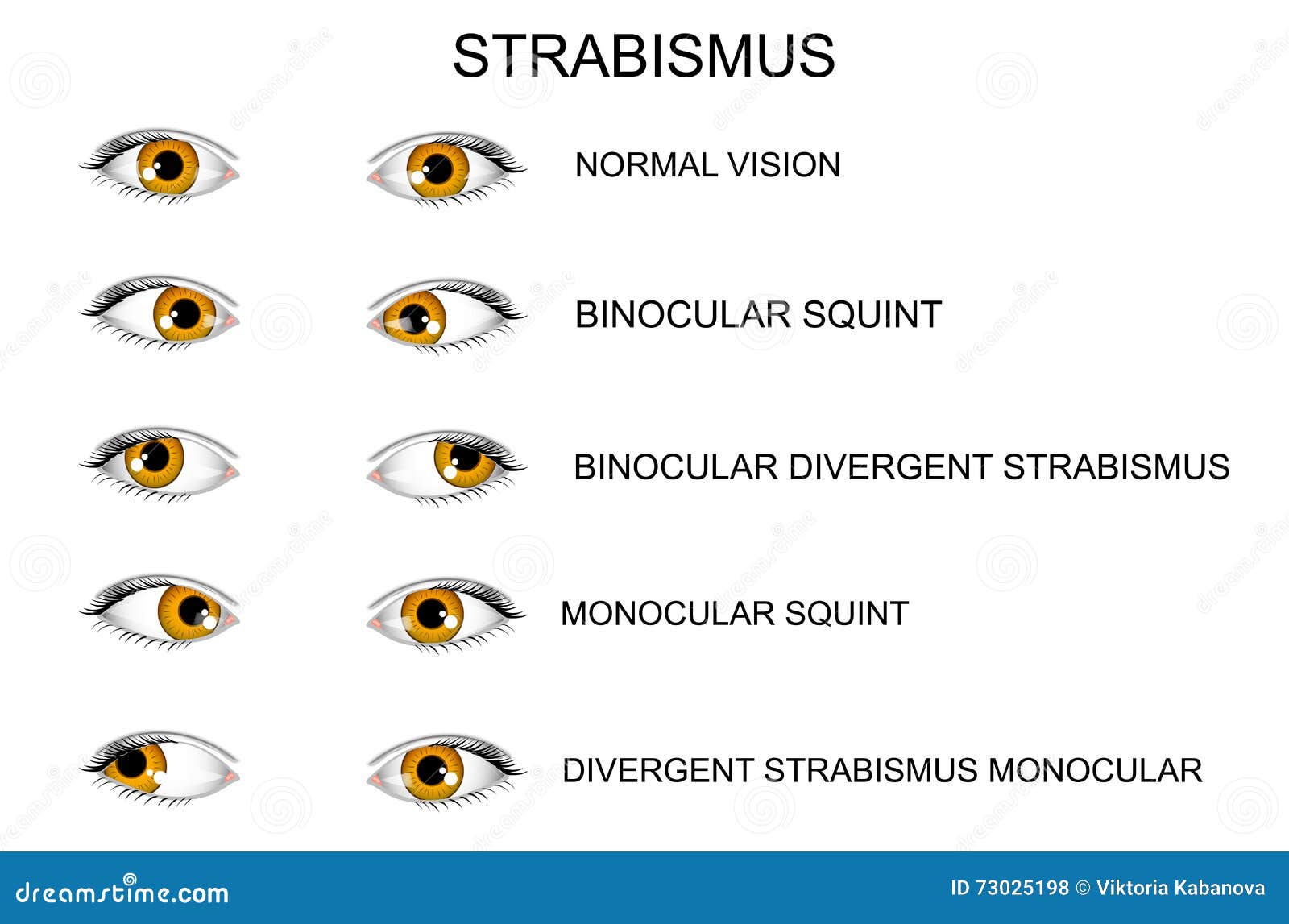Ojos tipos de estrabismo ilustración del vector. Ilustración de ajuste ...