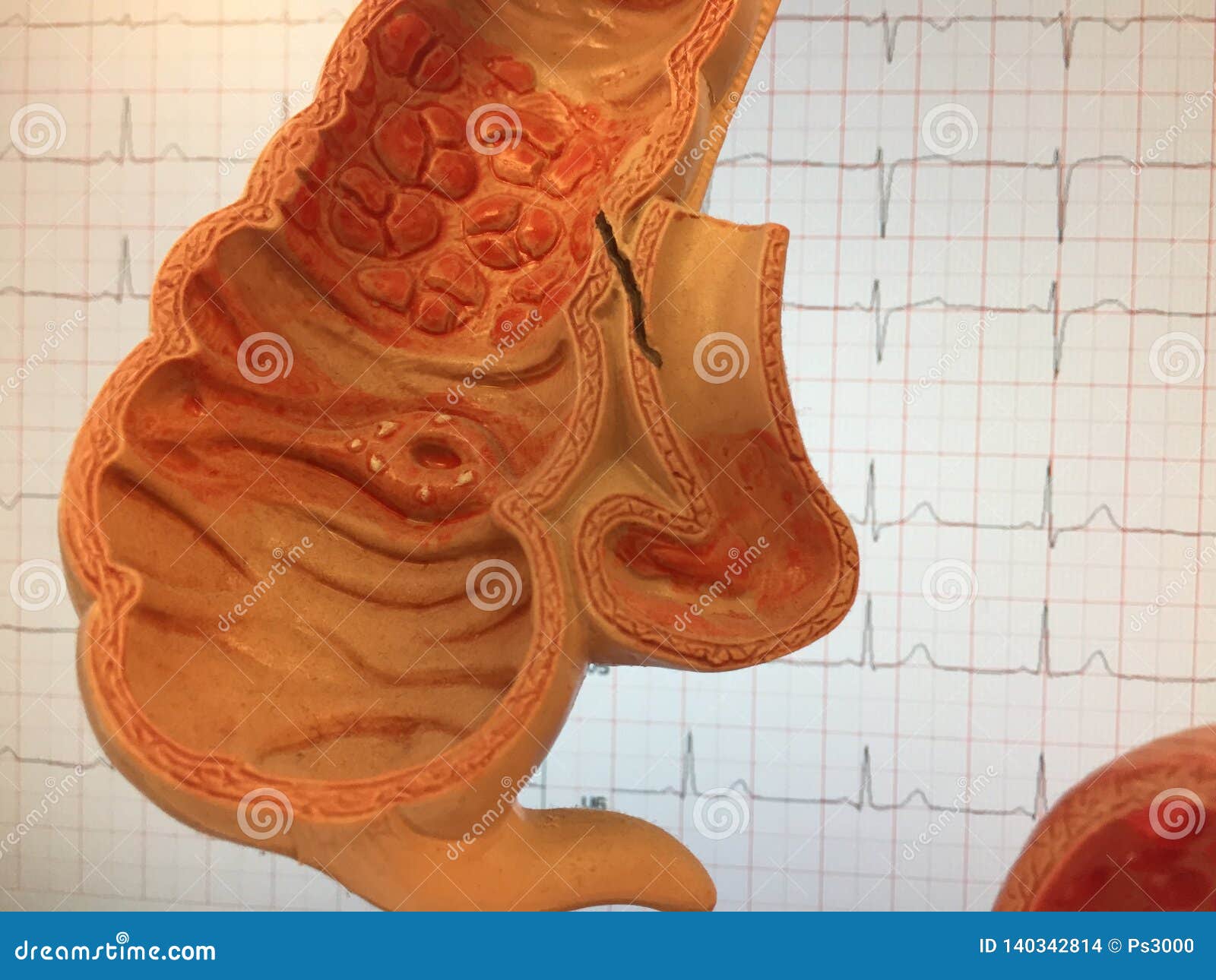 Old Anatomical Model of Colon with Examples of Different Diseases Stock ...