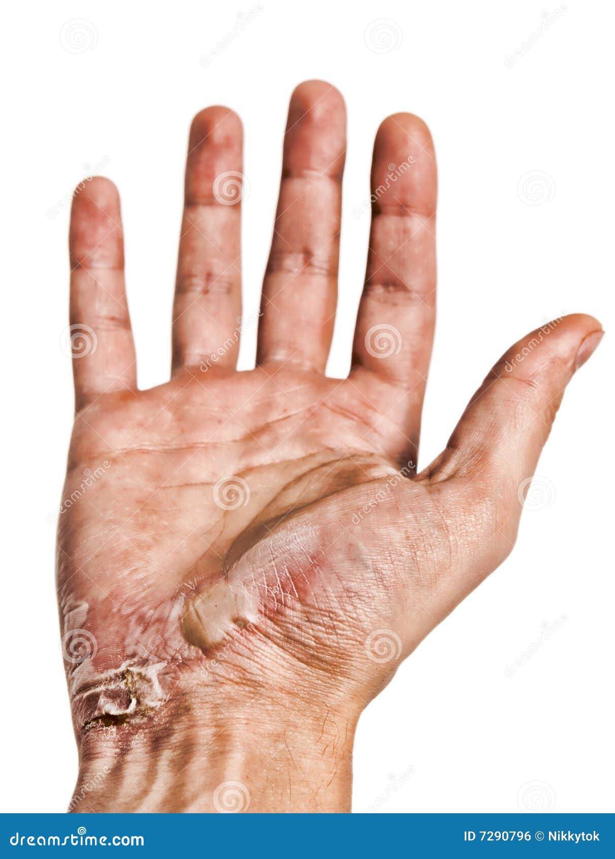 Old damaged hand stock photo. Image of unhealthy, poverty - 7290796