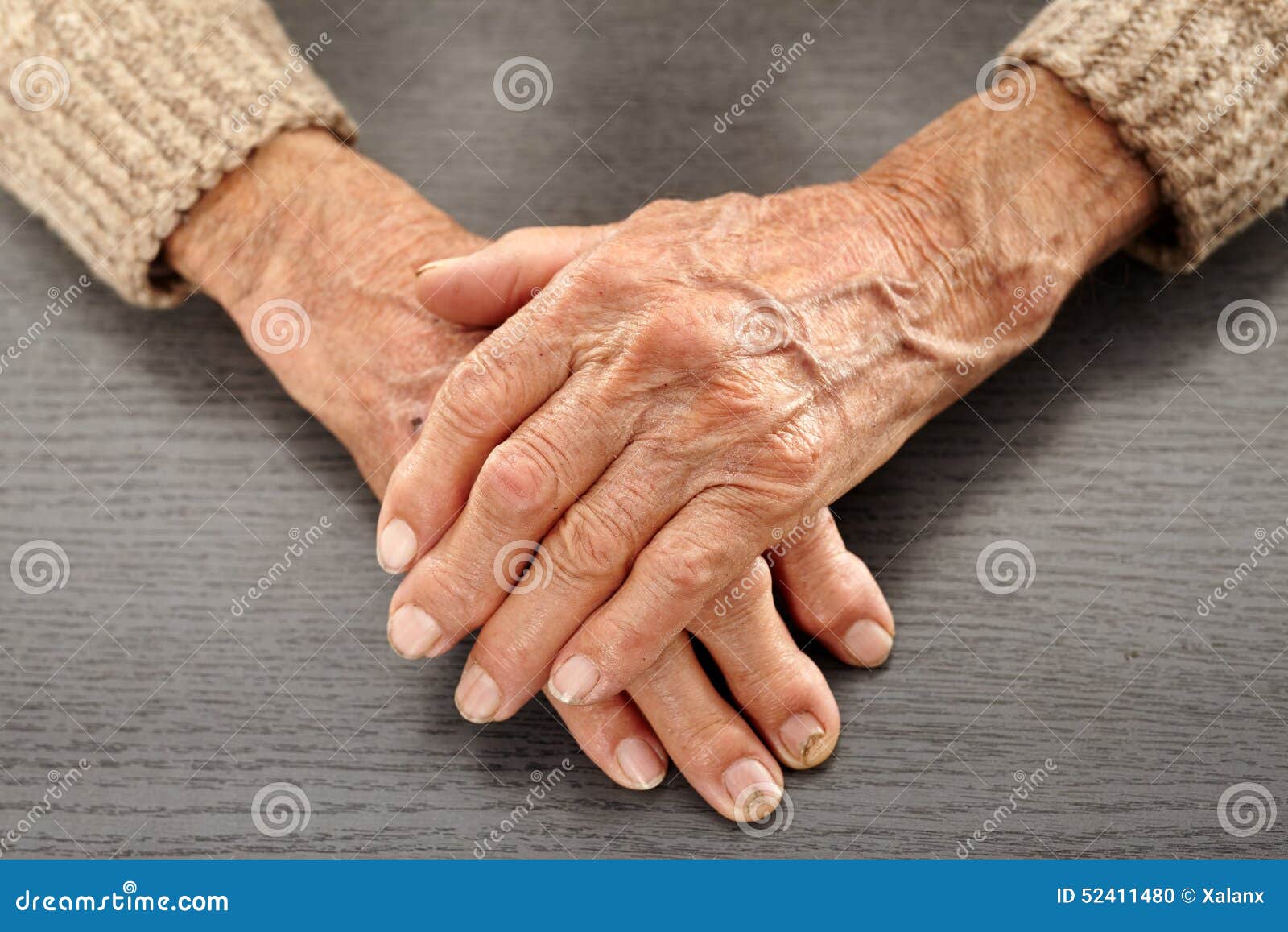 Old hands with artritis stock photo. Image of discomfort - 52411480