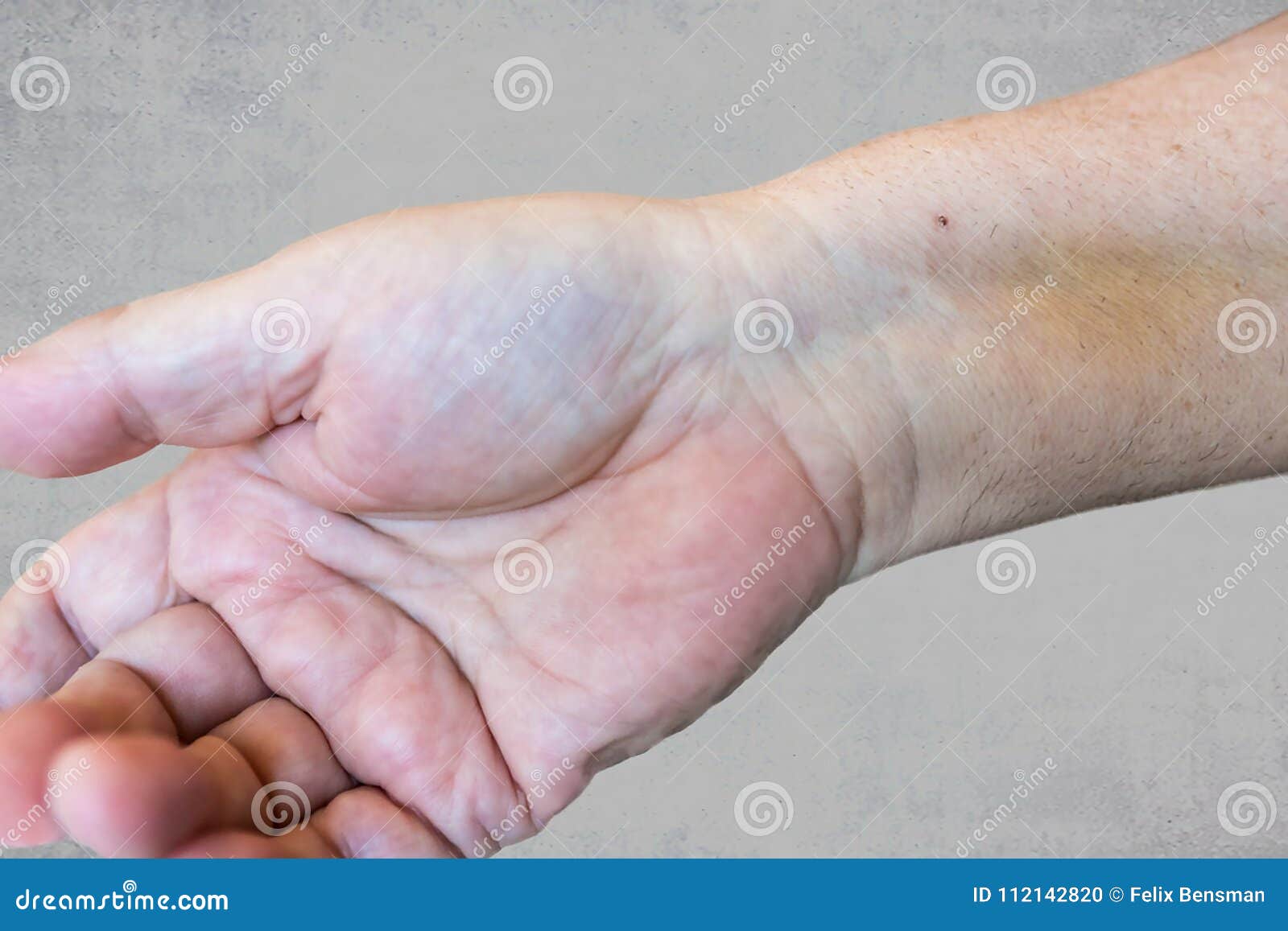 A Male Hand with a Trace of Point after Going through a Stent ...
