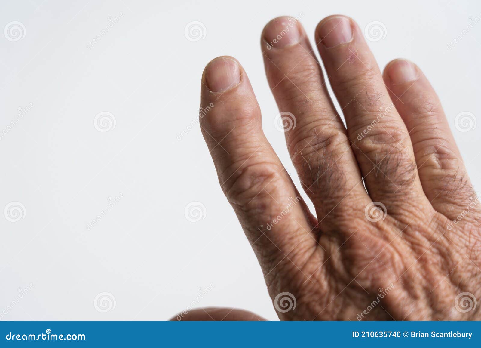Old Mans Hand with Bent and Lumpy Finger Joints Stock Photo - Image of ...
