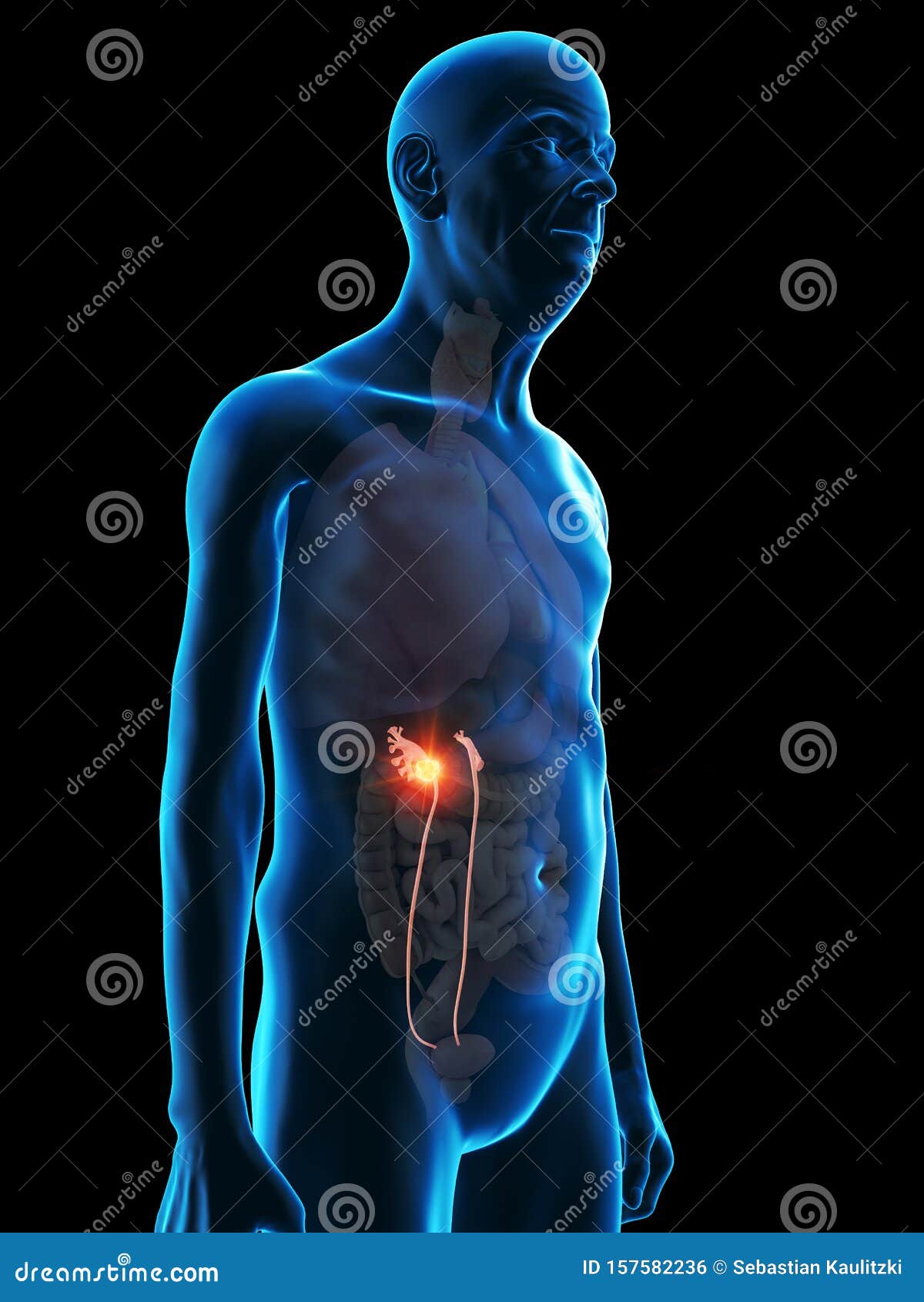 A Tumor Of The Ureter. Hydronephrosis. Setting Of Nephrostomy Tube ...