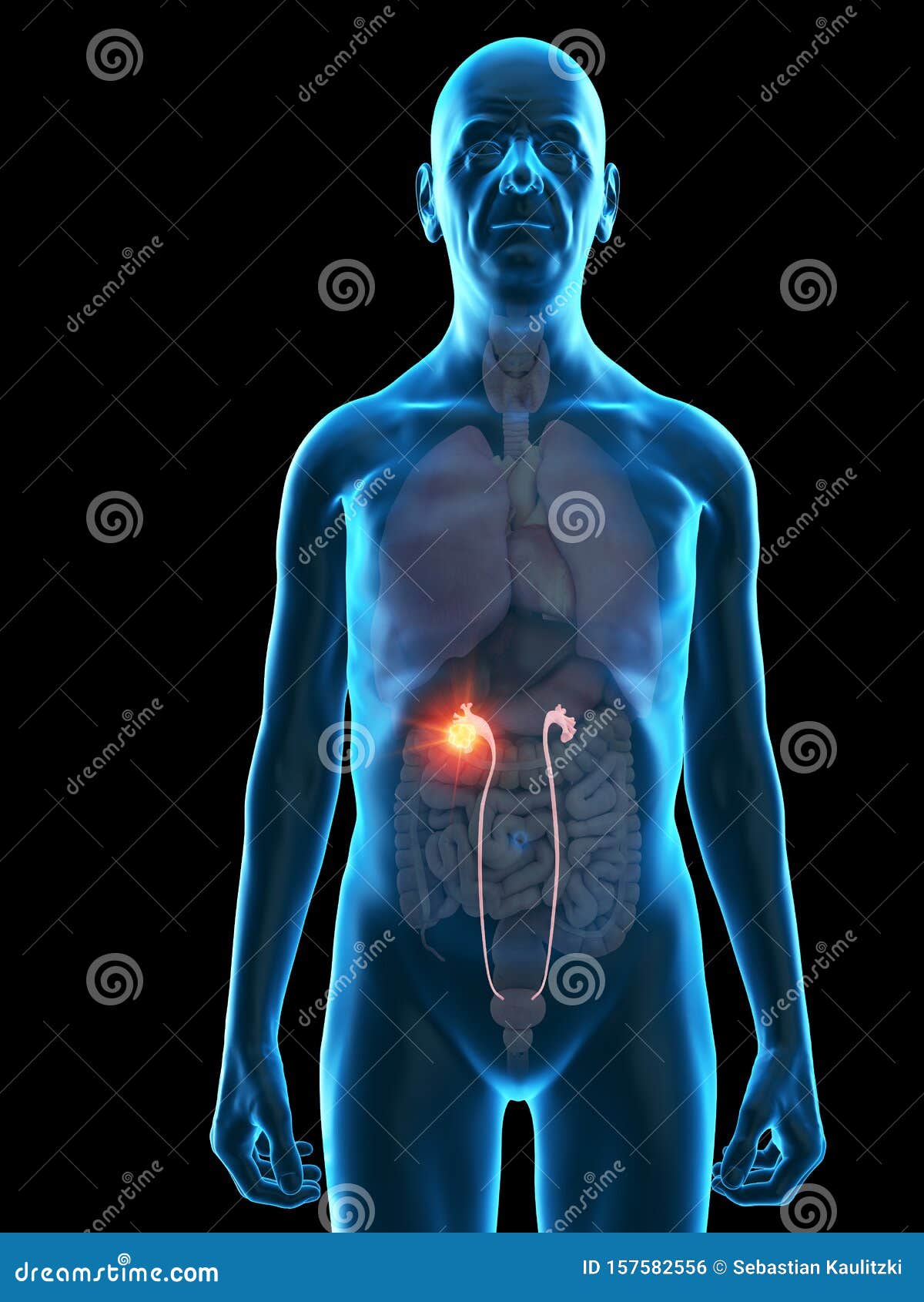 A Tumor Of The Ureter. Hydronephrosis. Setting Of Nephrostomy Tube ...