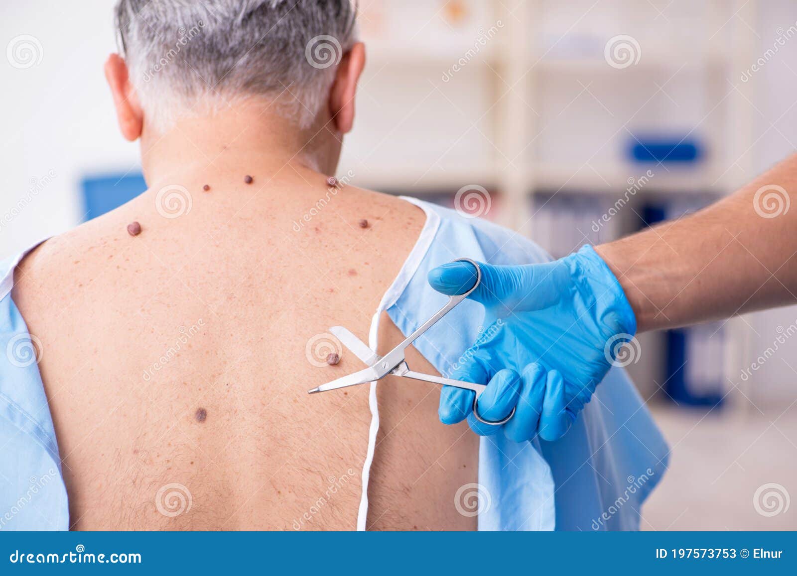 Doctor Dermatologist Checking Benign Mole Of Patient By Magnifying