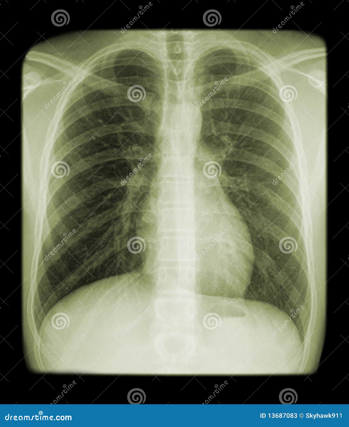 Old X-ray Picture of a Human Thorax Stock Image - Image of disease ...