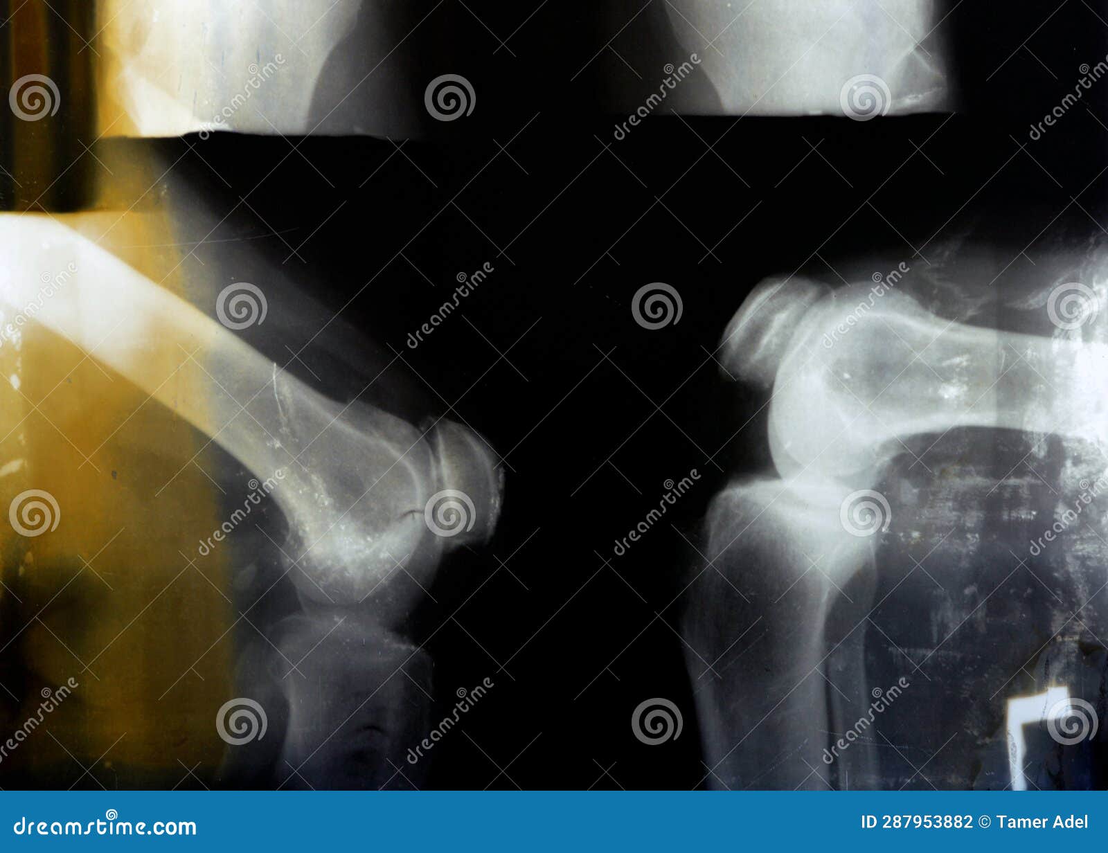 Old Retro Plain X Ray of the Right Knee Shows Apparent Joint ...