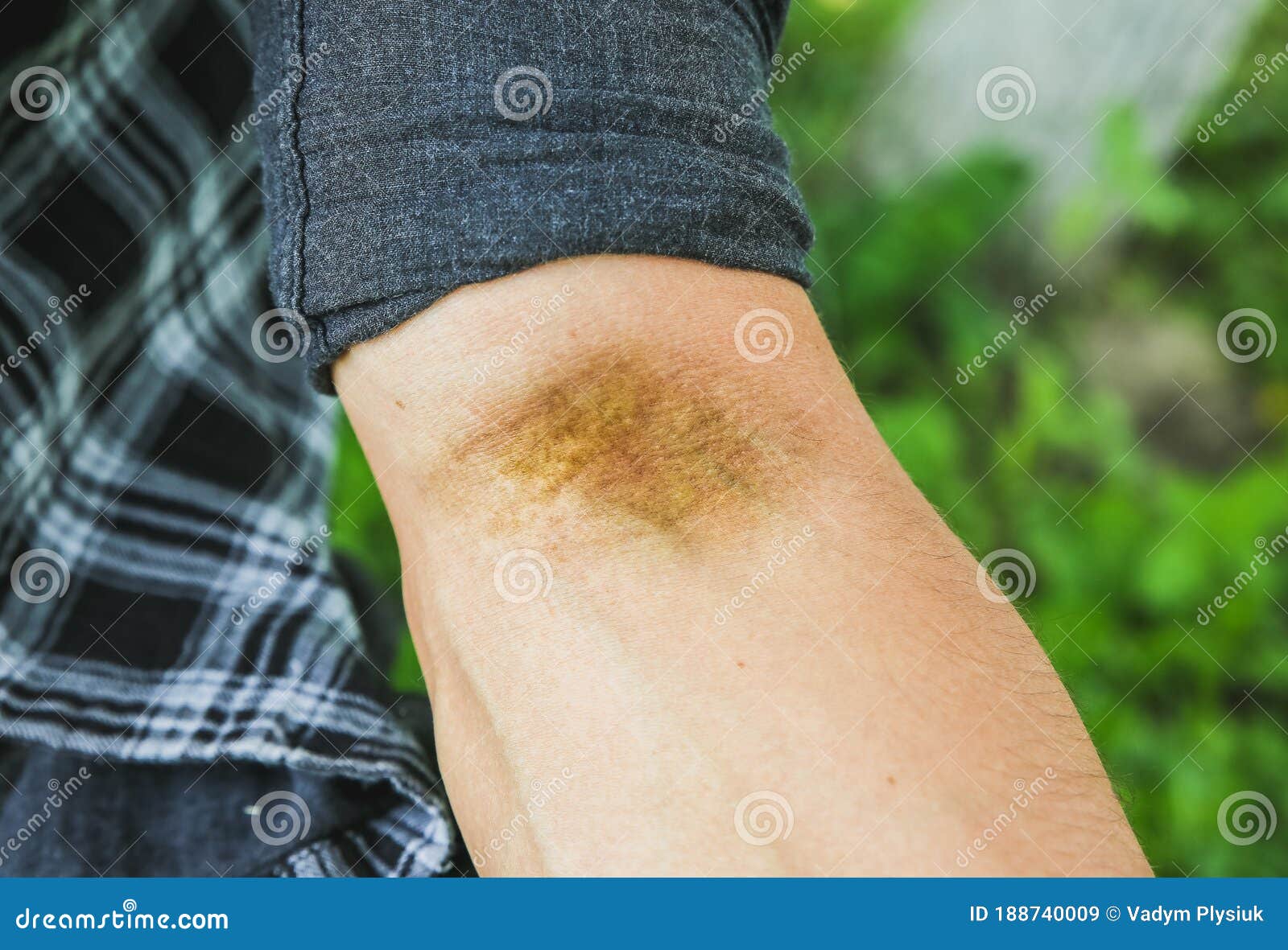 Old Scar on Man`s Arm. Accident in the Past Stock Image - Image of ...