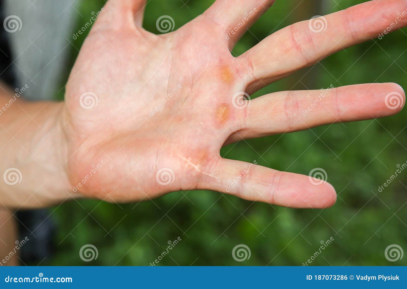 Old Scar on Man`s Hand. Accident in the Past Stock Photo - Image of ...