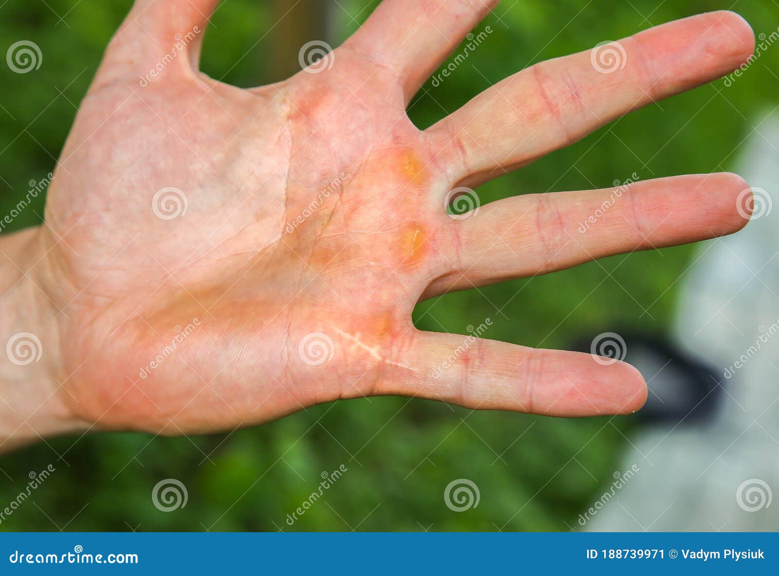 A Scar On The Hand - A Scratch Stock Photography | CartoonDealer.com ...