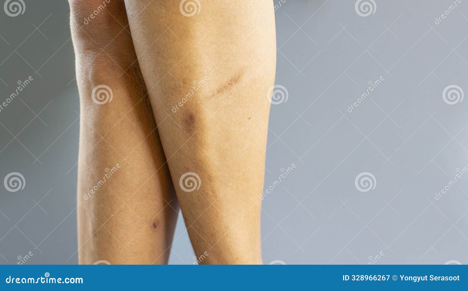 Old Scars on the Skin of the Legs Stock Image - Image of fungus ...