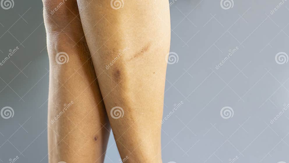 Old Scars on the Skin of the Legs Stock Image - Image of fungus ...