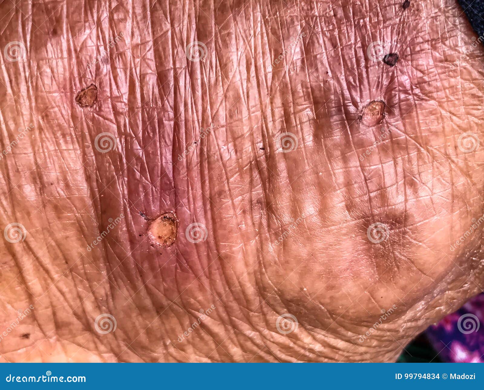 Lesion On Arm Skin Begin Scab Dried On The Epidermis. Stock Photo ...