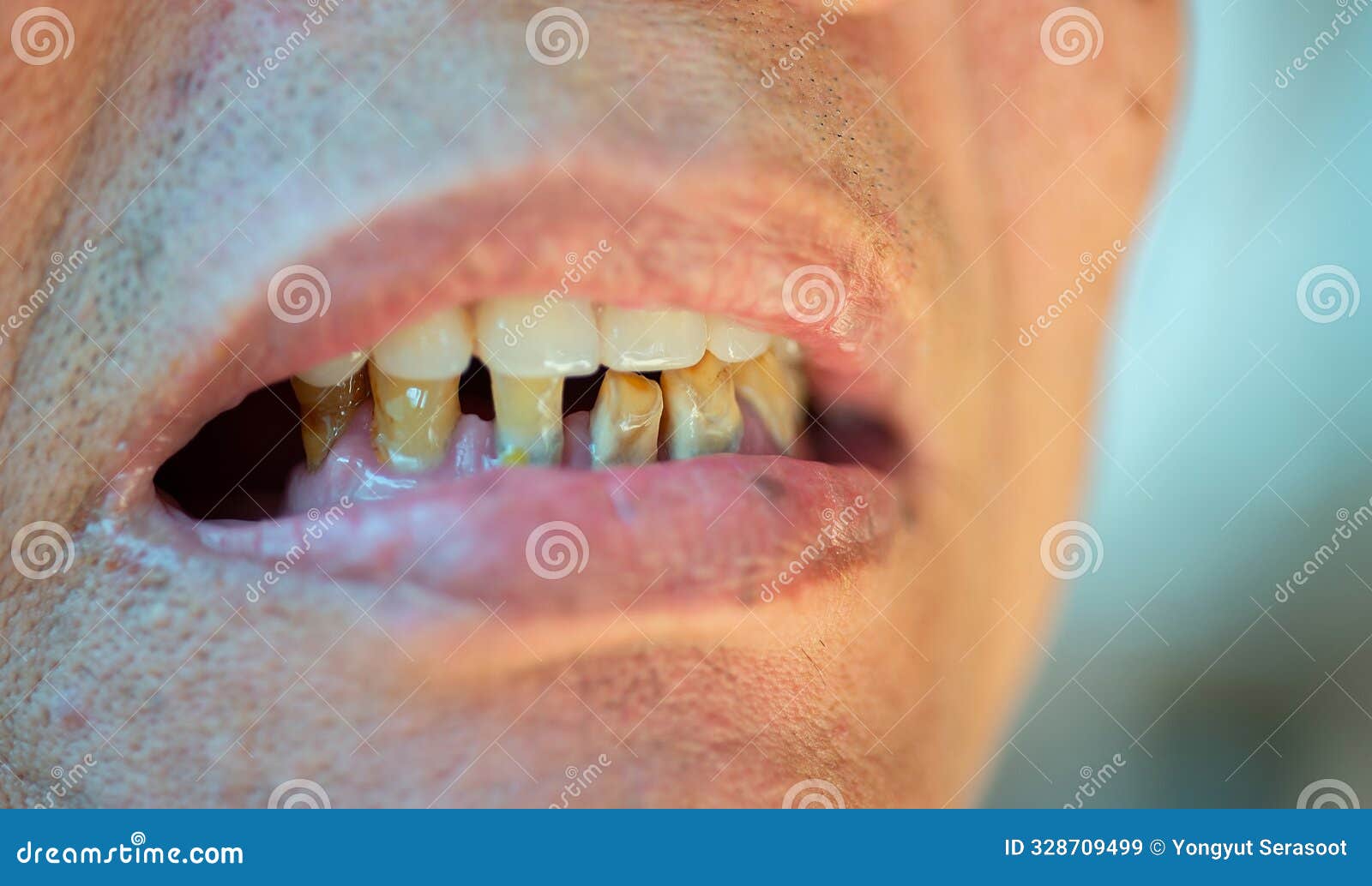 Old and Worn-out Elderly Teeth Stock Image - Image of dilapidated ...