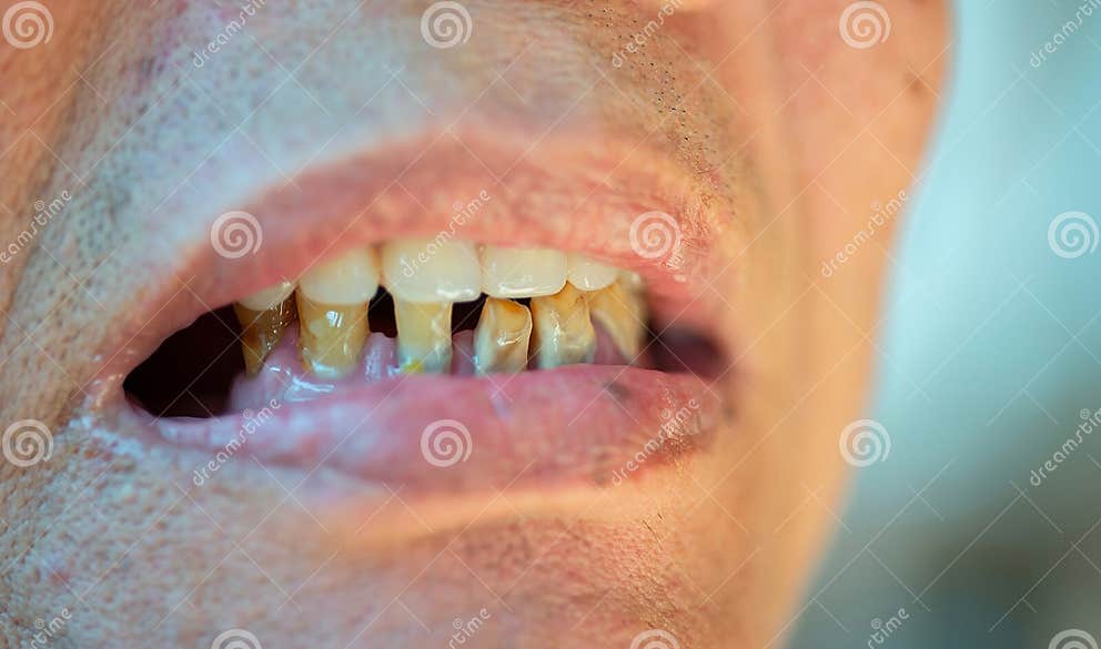 Old and Worn-out Elderly Teeth Stock Image - Image of dilapidated ...