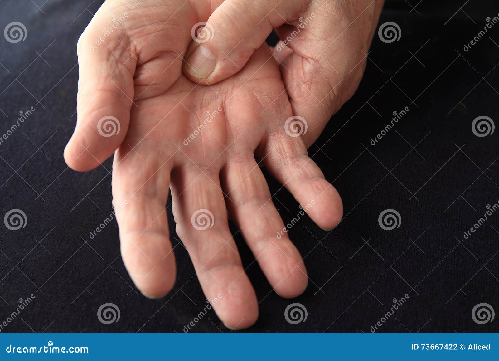 Painful Palm Of Asian Man. Concept Of Compartment Syndrome, Cellulitis ...