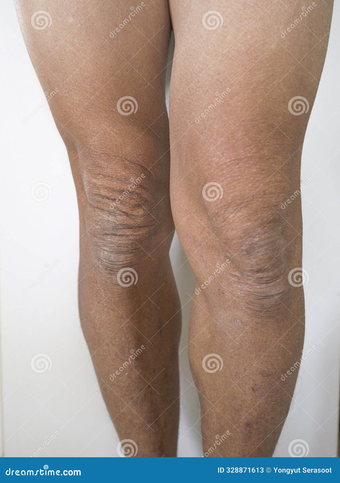 Older People S Leg and Knee Muscles Stock Image - Image of atrophy ...