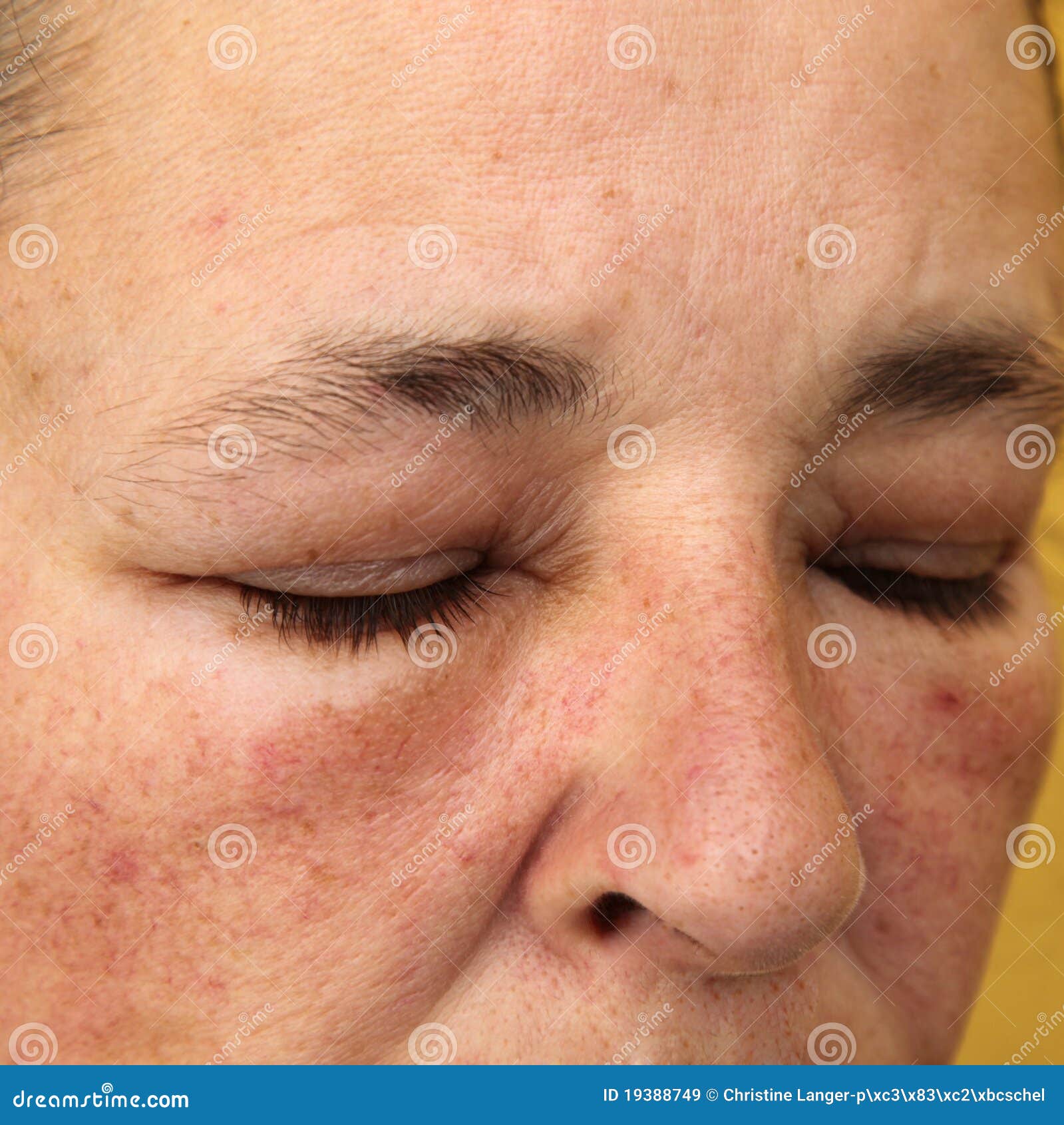 Olhos E Face Inchados Para a Alergia Imagem de Stock - Imagem de ...