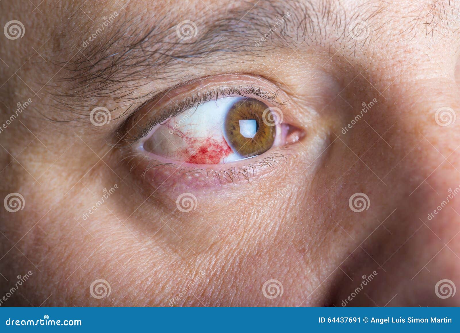 Olhos Vermelhos Do Bloddshot Imagem de Stock - Imagem de problema ...