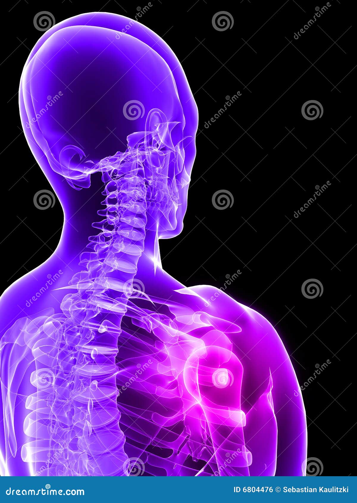 Ombro de Inflammated ilustração stock. Ilustração de espinha - 6804476