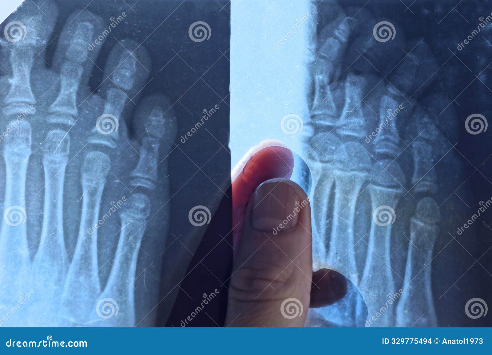 One Black and White X-ray Part of the Hand from the Wrist Stock Photo ...