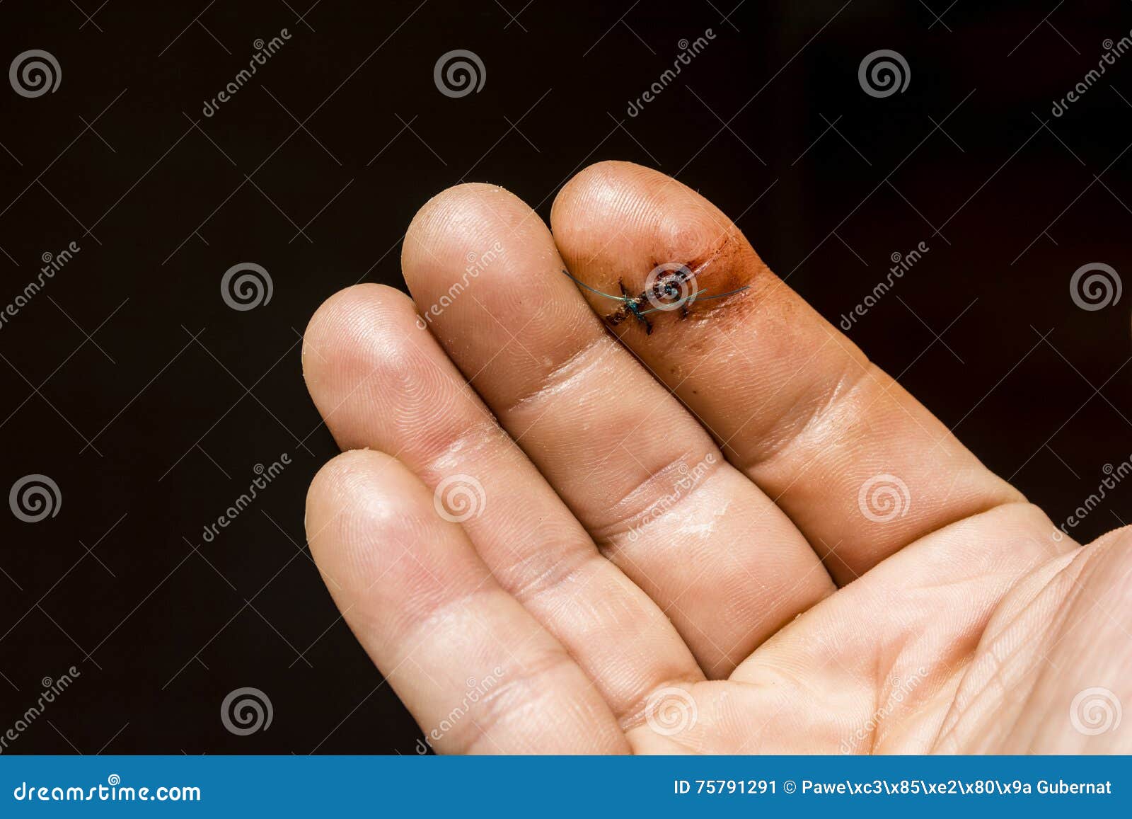 On One Finger of the Hand they are Founded Two Non-absorbable Surgical ...