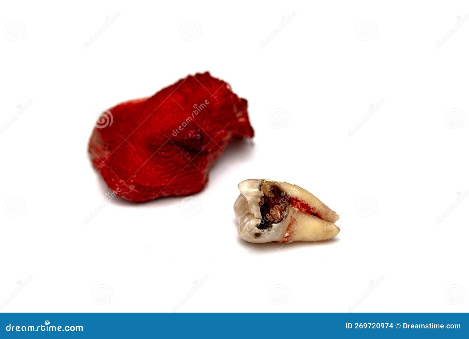 One Molar Tooth Decay Extracted and Placed on a White Background. the ...