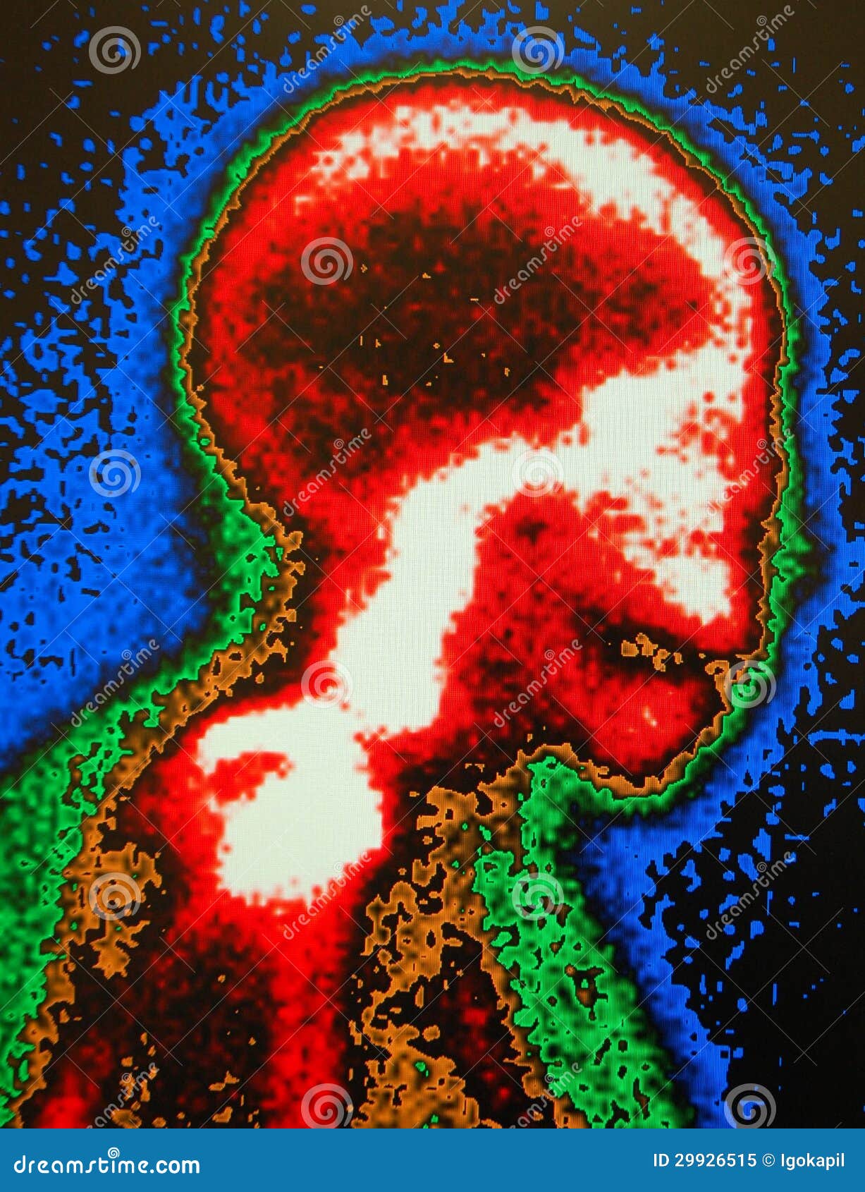 Skull, CT-scan Reconstruction, Anatomy Royalty-Free Stock Image ...