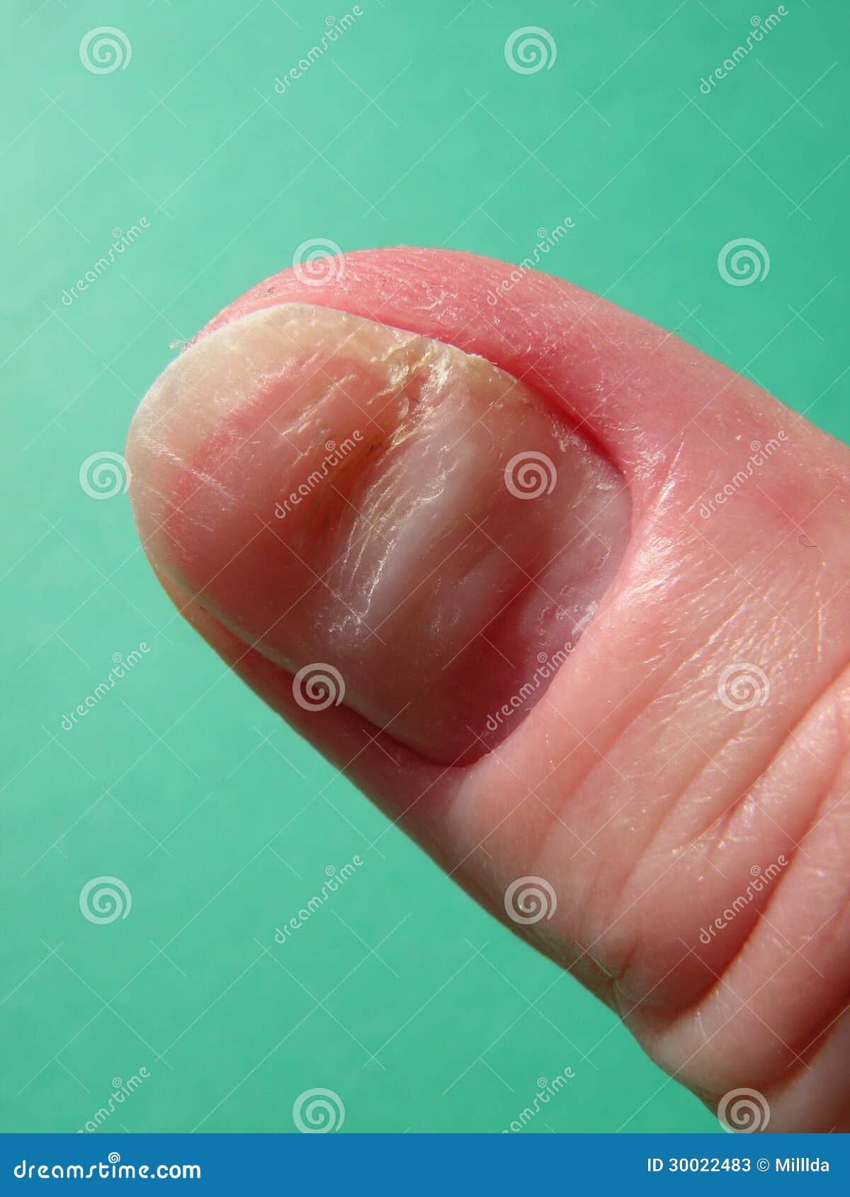 Ongle Malade Cassé Sur Le Doigt Image stock - Image du peinture, peau ...