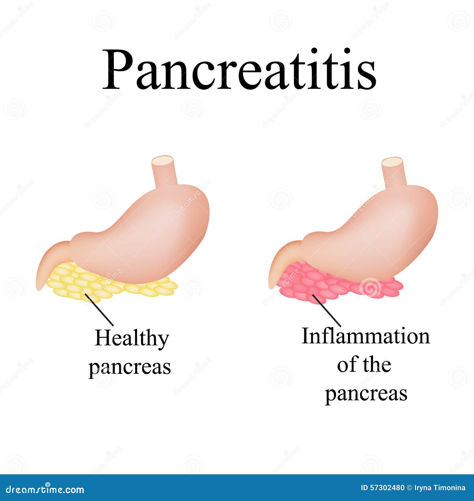 Ontsteking Van De Alvleesklier Pancreatitis Vector Vector Illustratie ...
