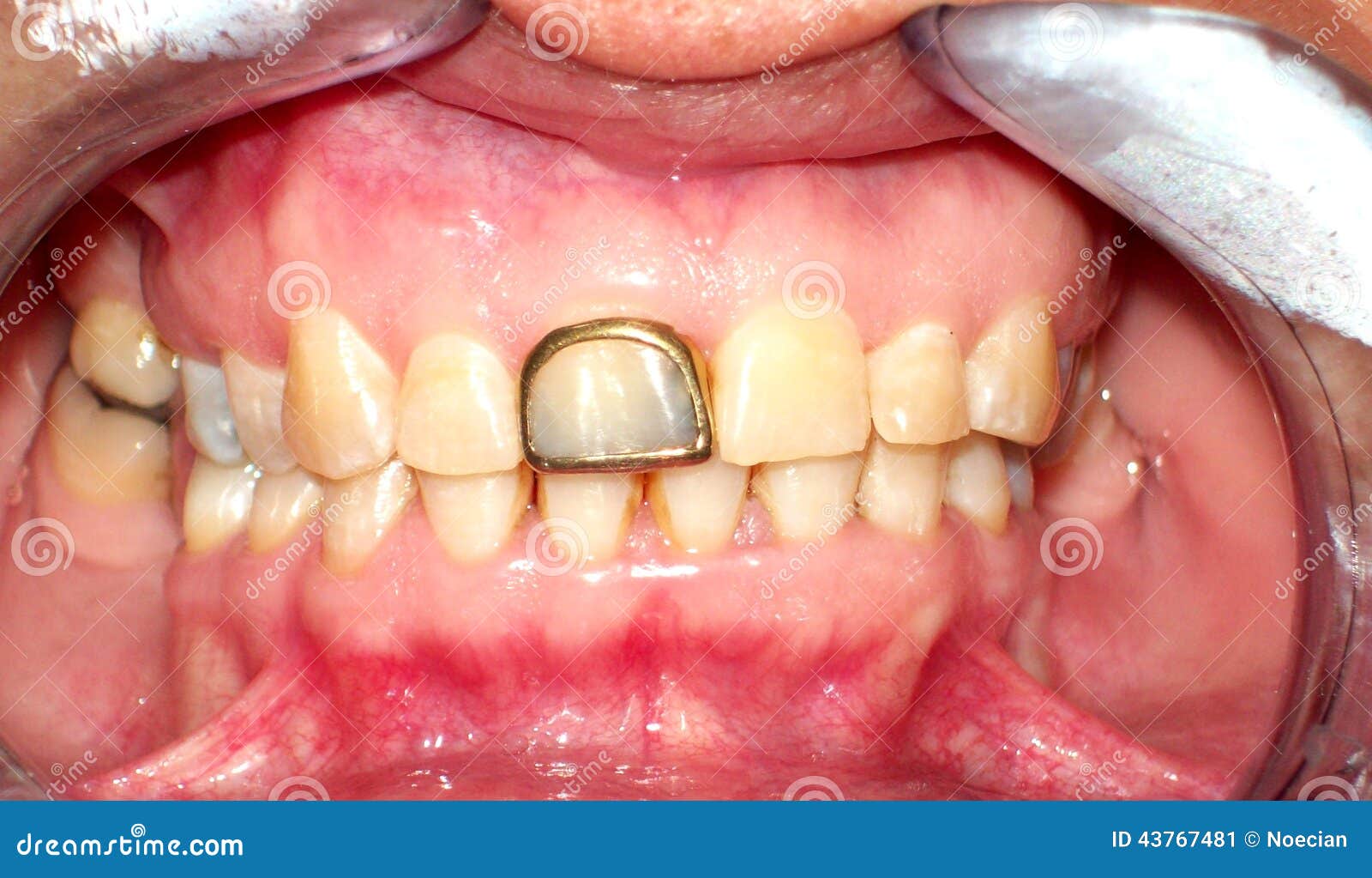 Onvolledige Tand Gouden Kroon Stock Afbeelding - Image of centraal ...