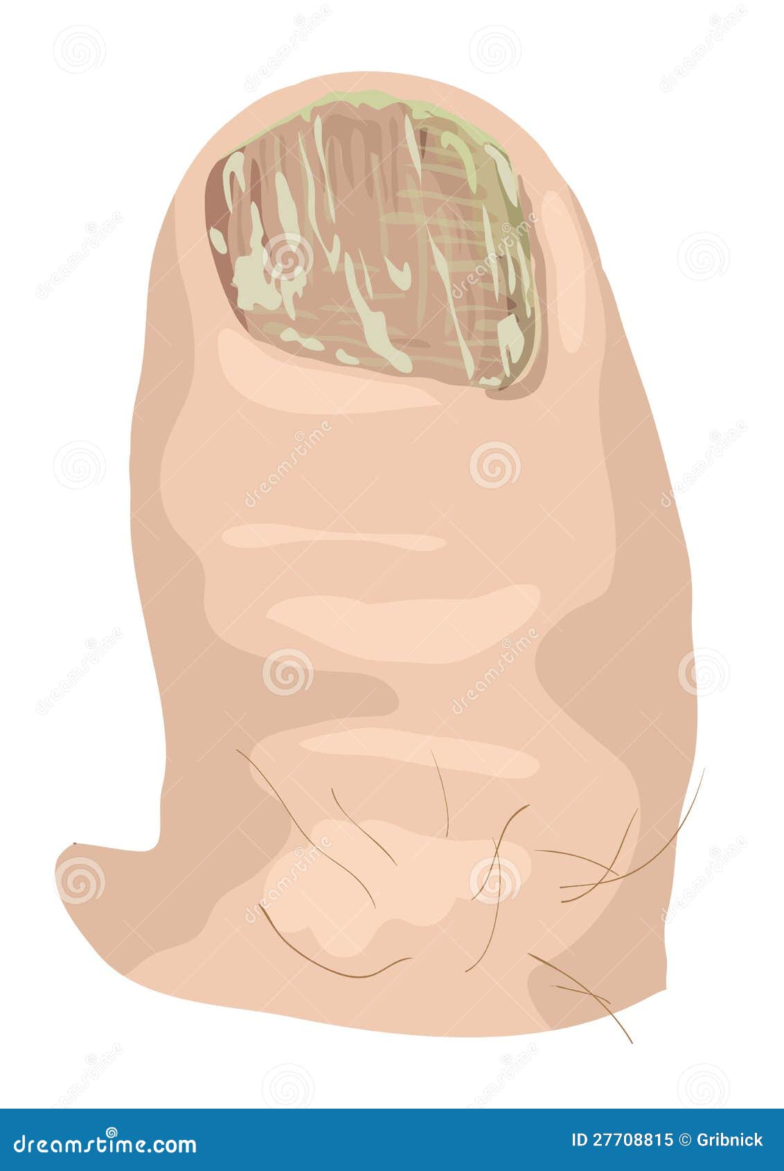 Onychomycosis. stock vector. Illustration of chiropody - 27708815