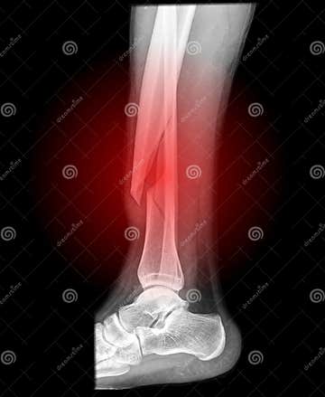 Open Fracture of the Leg with Dislocation Stock Illustration ...