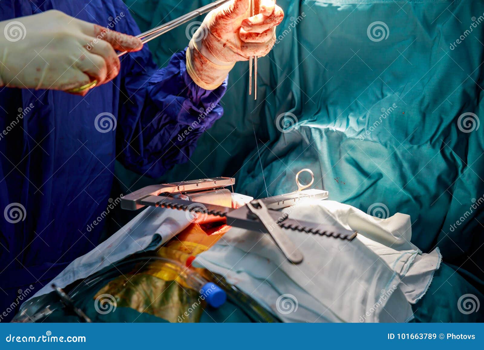 Open Heart Cardiac Bypass Surgery in Operation Room Stock Image - Image ...