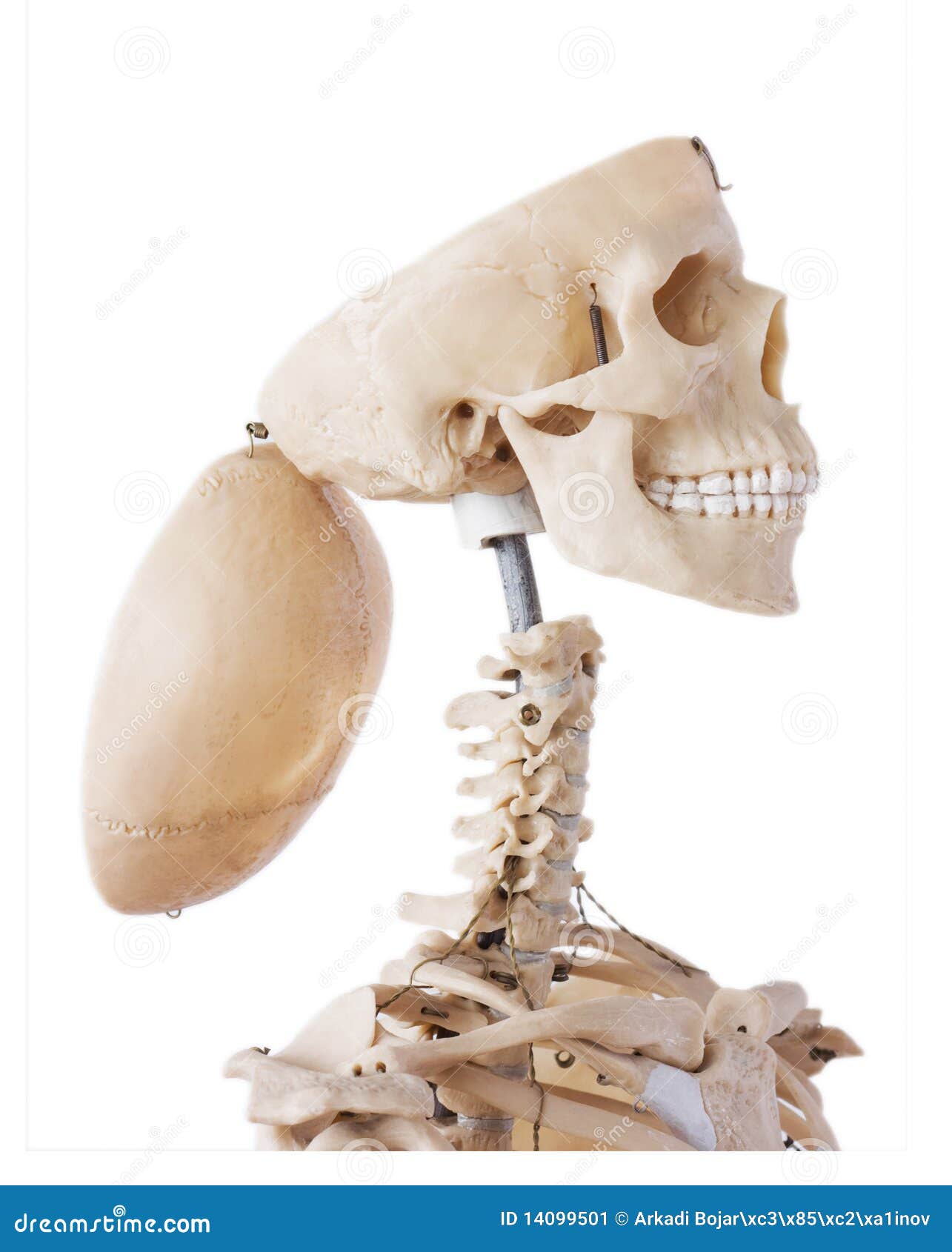 X-ray Skull Open Mouth ( Side View ) And Stroke ( Cerebrovascular ...