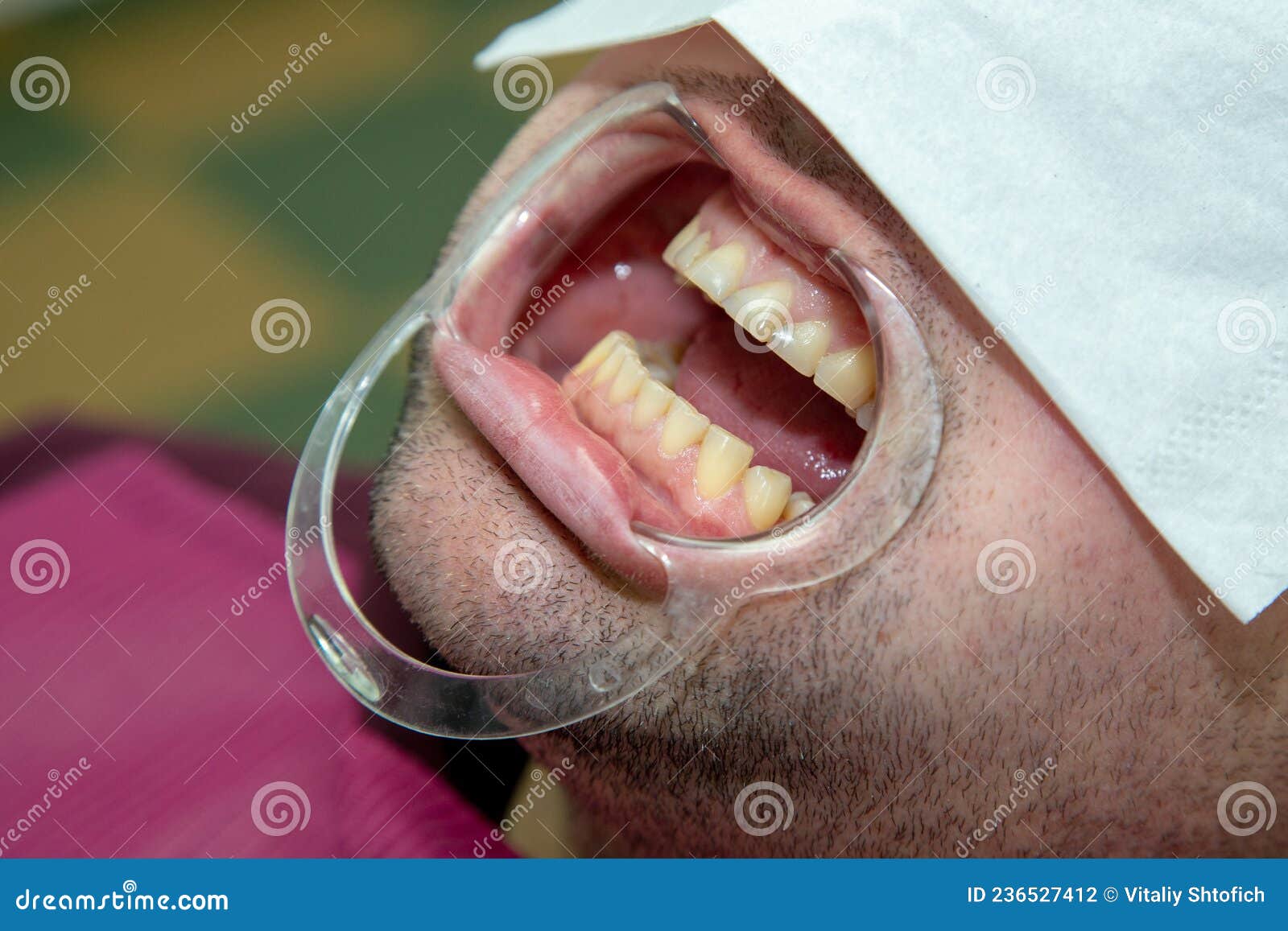 Open Mouth for Dental Treatment Stock Photo - Image of glove, hygiene ...