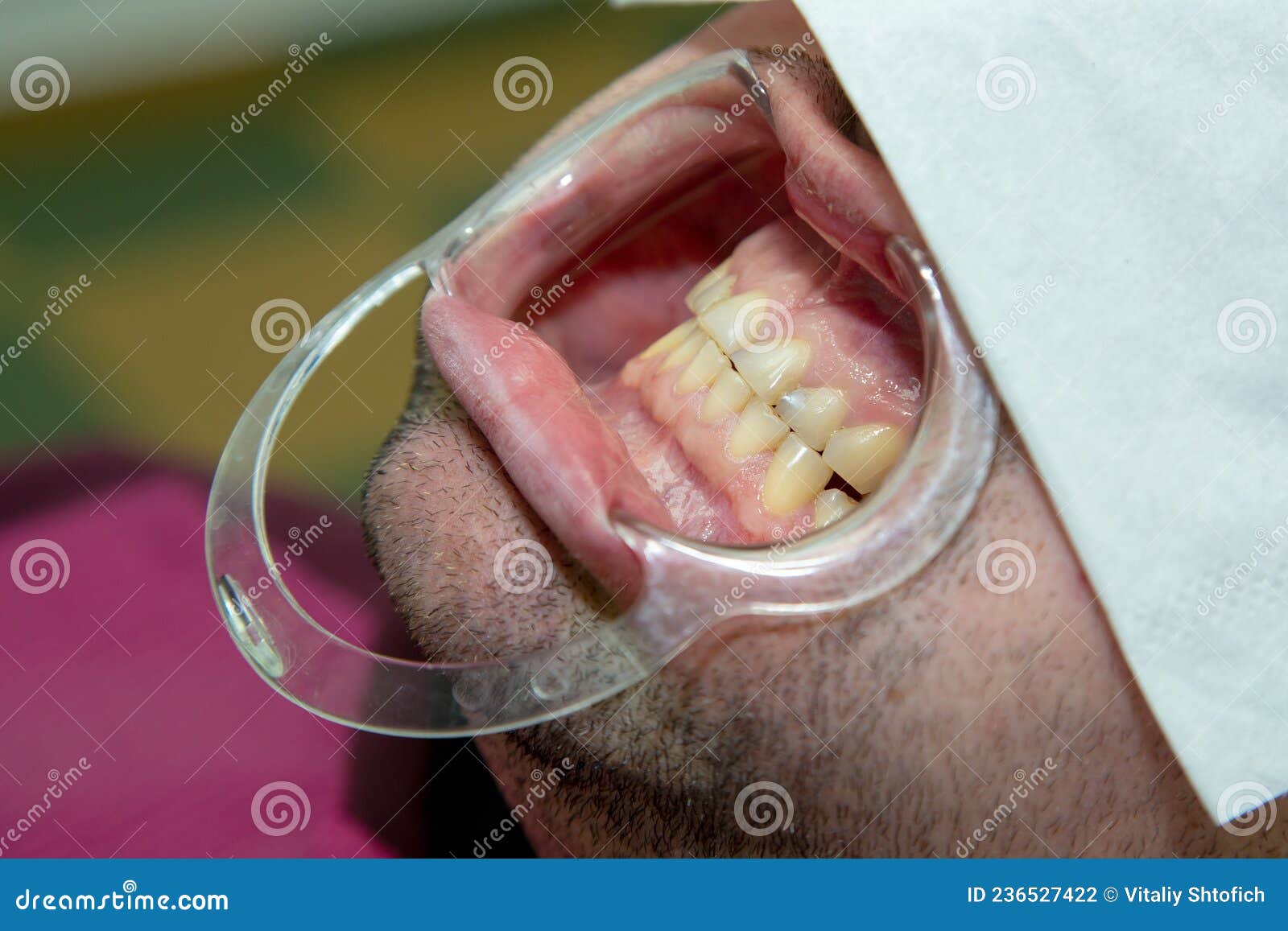 Open Mouth for Dental Treatment Stock Photo - Image of furniture, close ...