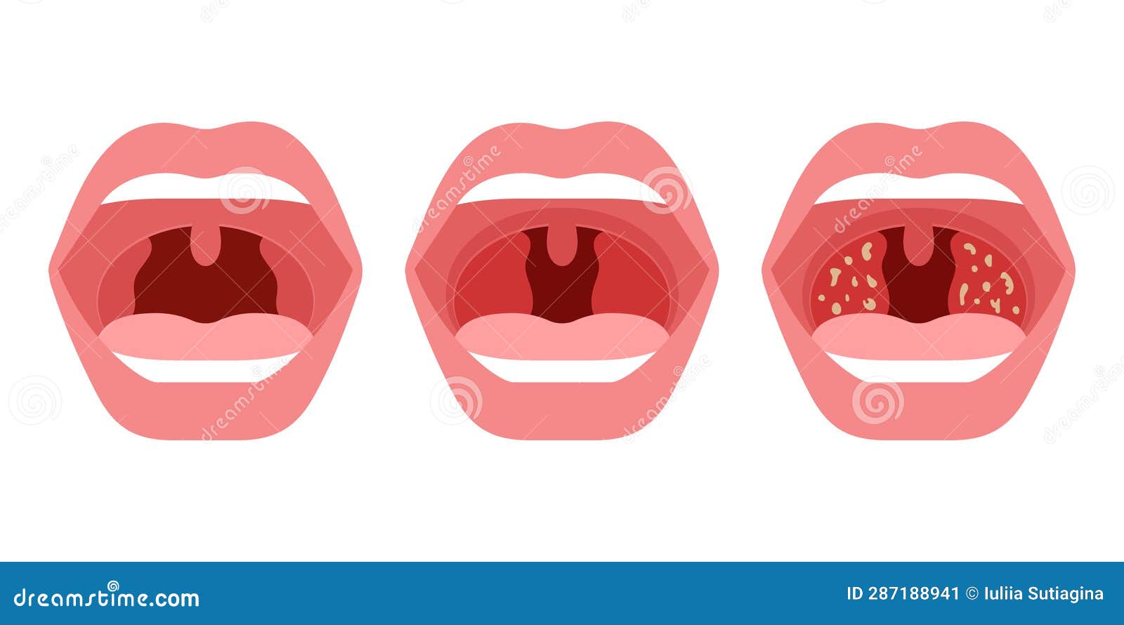 Open Mouth With Health And Sick Throat Of Human Comparison Healthy Throat Tonsillitis