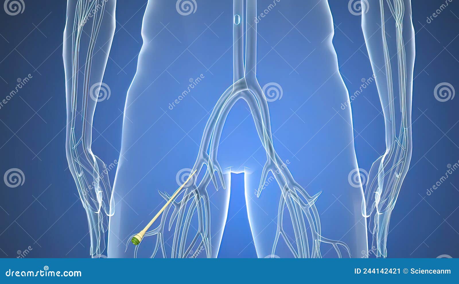 Opening the Occluded Artery by Inserting a Stent Stock Illustration ...