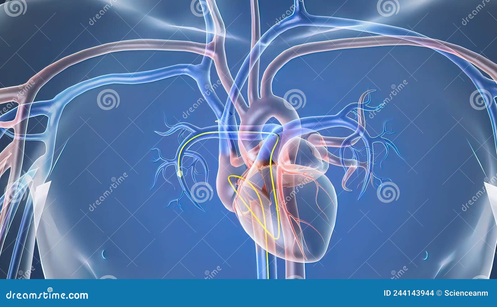 Opening the Occluded Artery by Inserting a Stent Stock Illustration ...