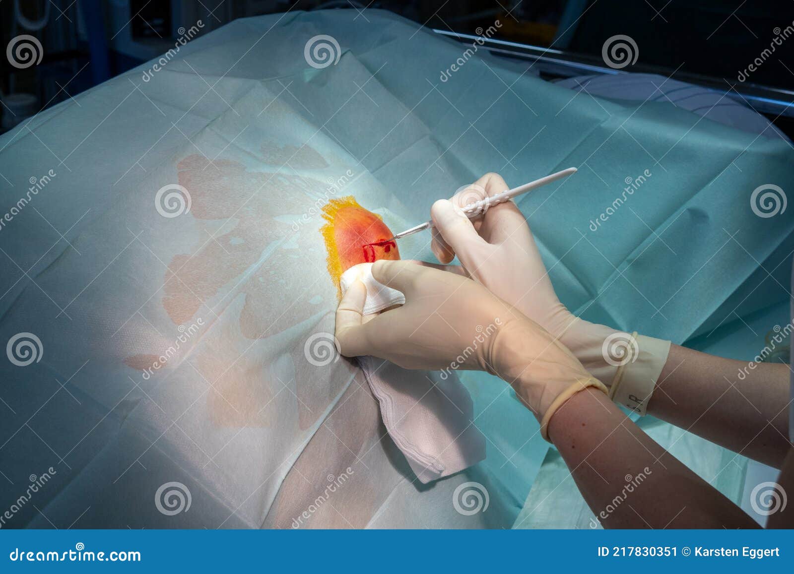 In the Operating Room the Abscess of a Patient is Operated by a Doctor ...