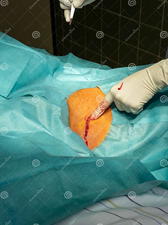 In the Operation an Abscess is Opened by a Doctor Stock Image - Image ...