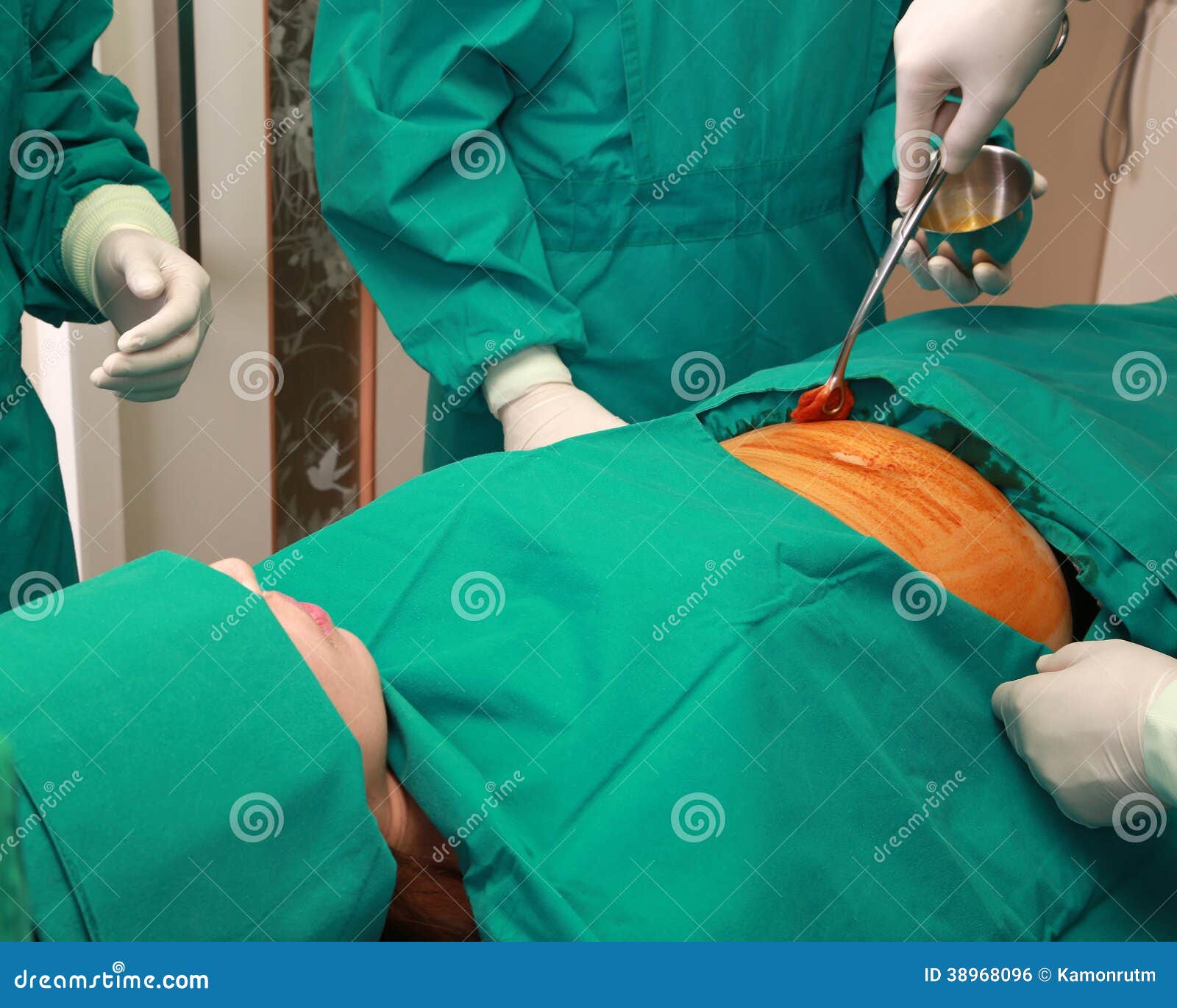 Operation Being Performed on a Stomach Stock Photo - Image of gloves ...