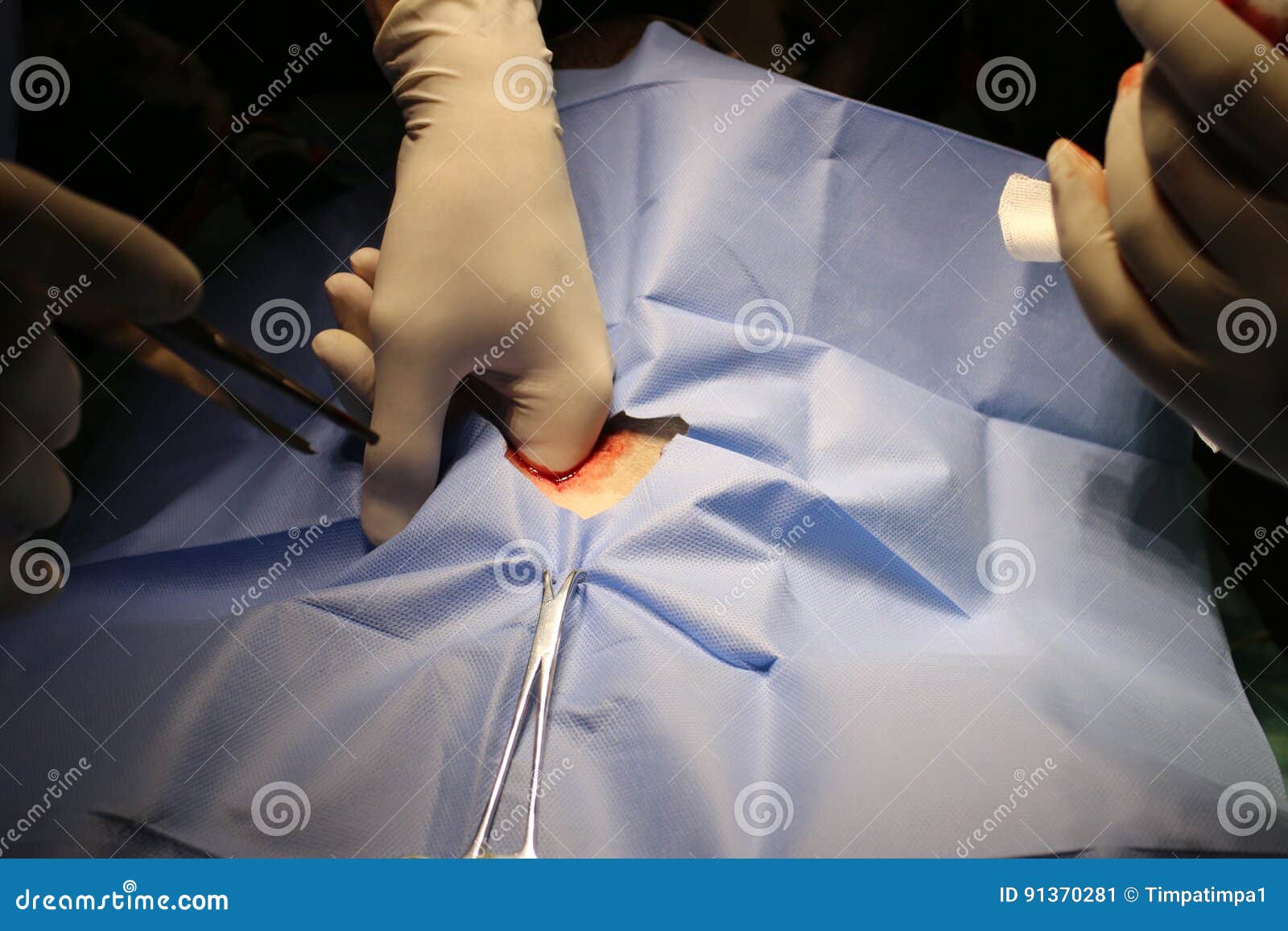 Oophorectomy Or Surgical Removal Of Ovary Or Ovaries Concept ...