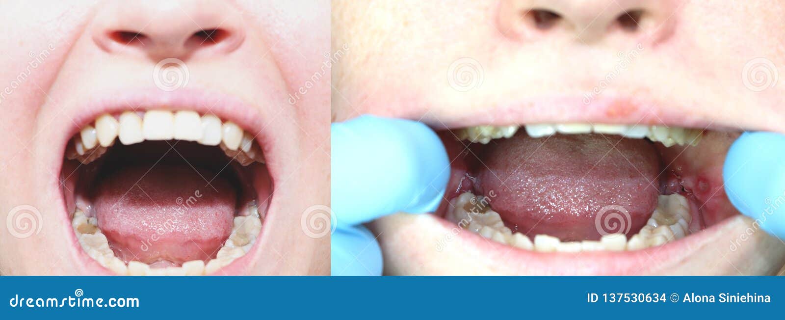 Before and after the Operation To Remove Wisdom Teeth - Eights. Close ...